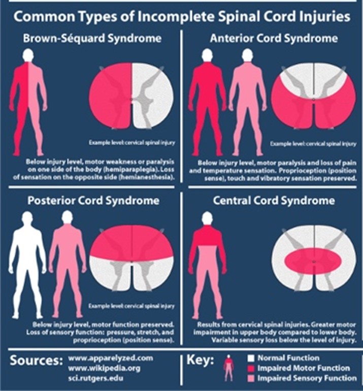 Most Common Spinal Cord Injuries Types And Causes McLeish Orlando LLP